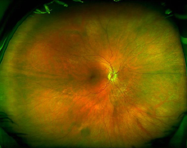 Optos: automated artefact detection - CENSIS